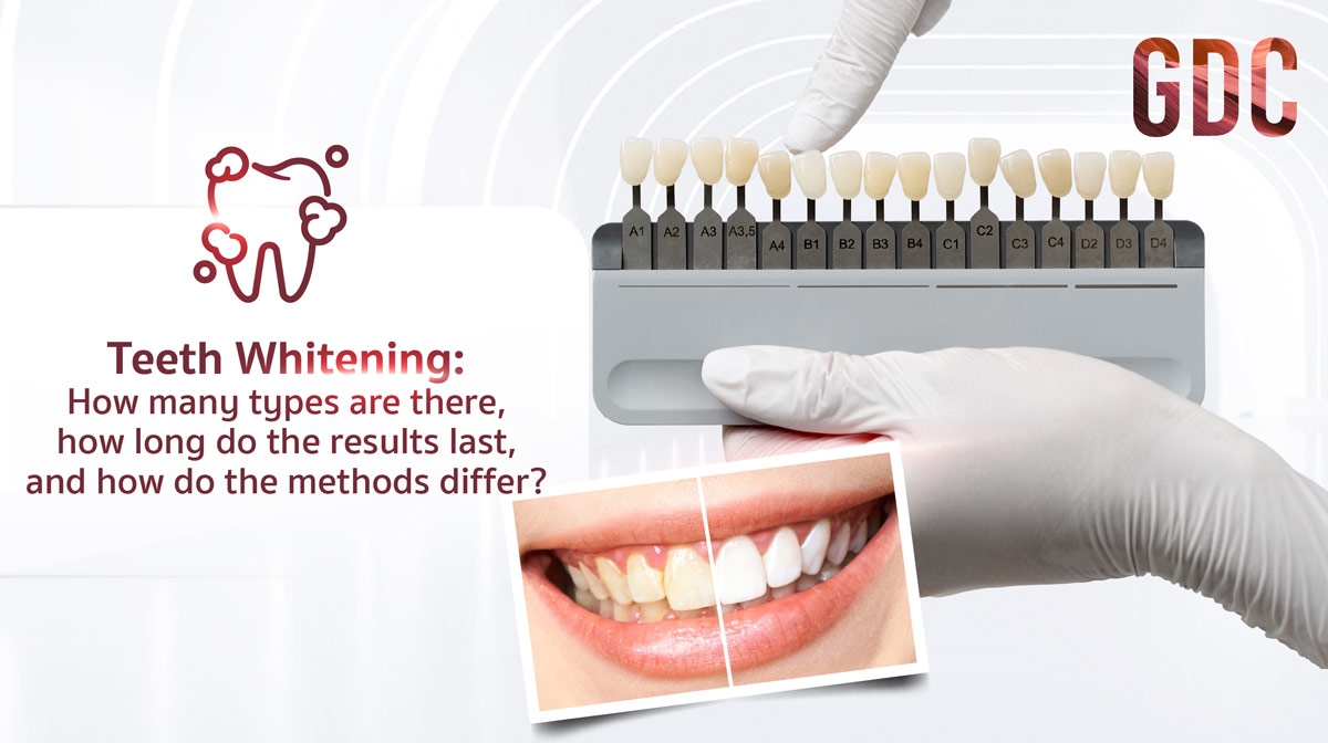 Teeth Whitening Types , Longevity, and Key Differences - GDC Dental Clinic